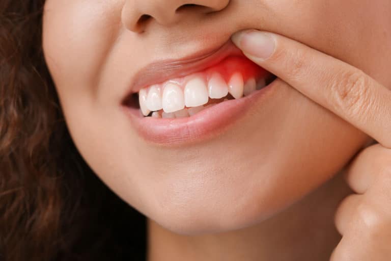How To Shrink Gum Pockets? (Periodontal Pockets)